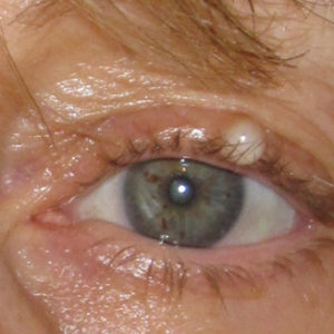 Online Stye Treatment in NY, NJ & CT | Eyelid Doctor | The StyeGuy