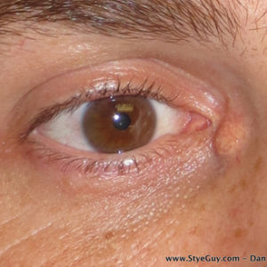 Online Stye Treatment in NY, NJ & CT | Eyelid Doctor | The StyeGuy