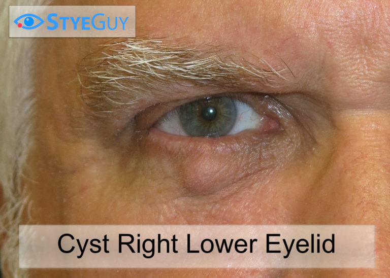 Cyst Styeguy