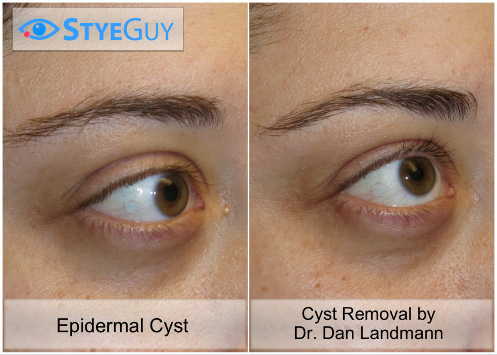 Epidermal Cyst Styeguy
