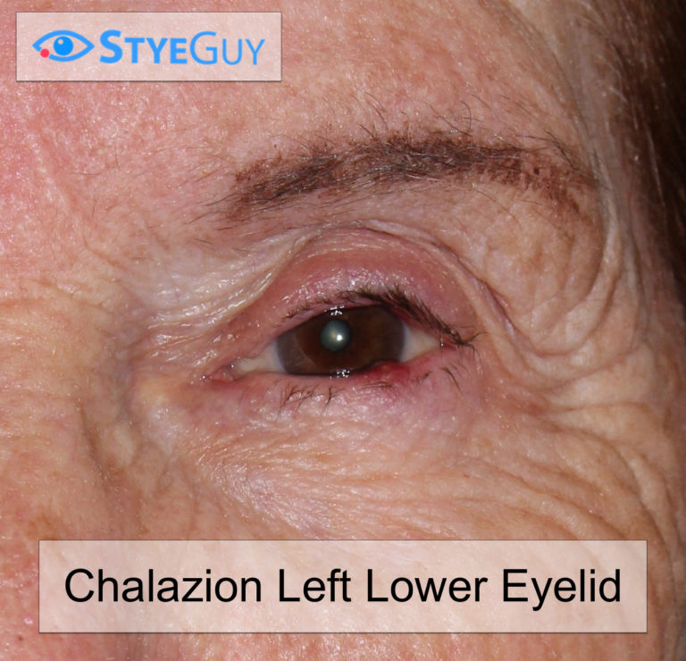 Chalazion Cyst Styeguy