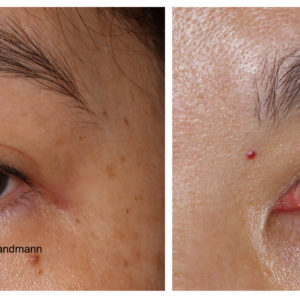 Online Stye Treatment in NY, NJ & CT | Eyelid Doctor | The StyeGuy