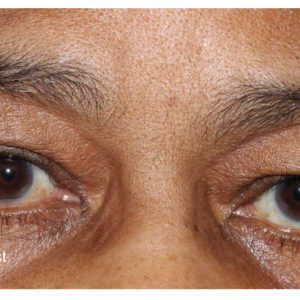 Online Stye Treatment in NY, NJ & CT | Eyelid Doctor | The StyeGuy