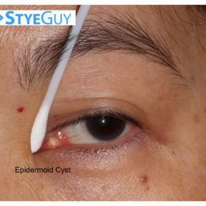 Online Stye Treatment in NY, NJ & CT | Eyelid Doctor | The StyeGuy