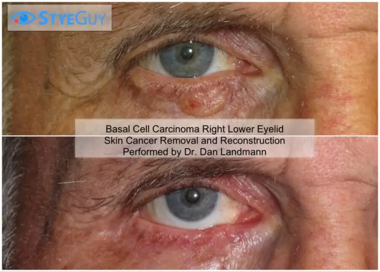 Stye Surgery Near Hasbrouck Heights | Eye Stye Removal | StyeGuy