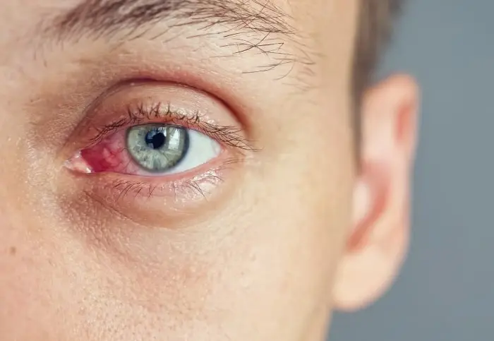 Stye Surgery Near Hasbrouck Heights | Eye Stye Removal | StyeGuy